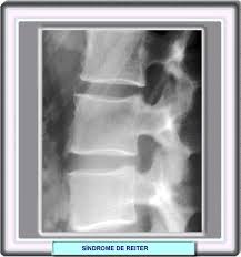 Síndrome de Reiter; Doença de Reiter – Espaço de José Marcos- DOENÇAS ...